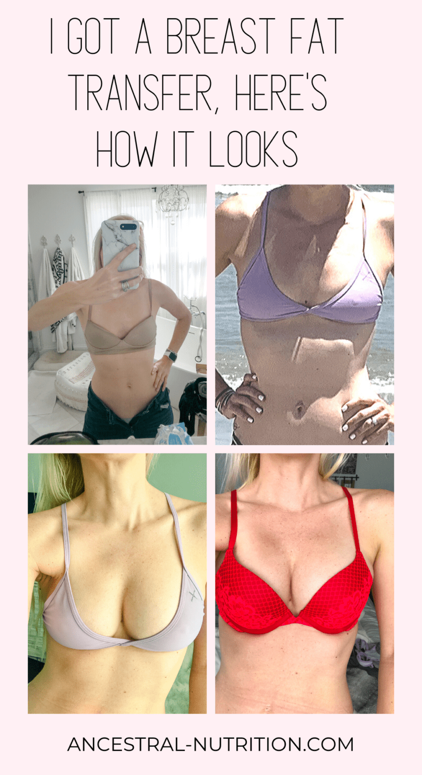 Before And After Breast Fat Transfer Ancestral Nutrition 1943